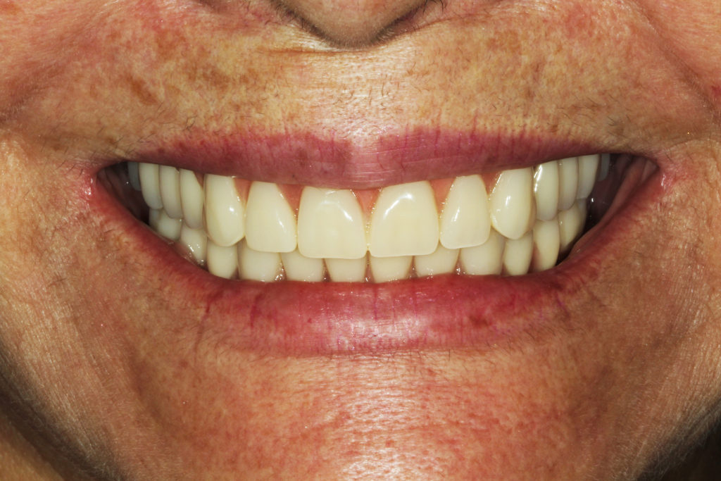 Próteses dentárias - Dra. Maria Cecilia Giacomel